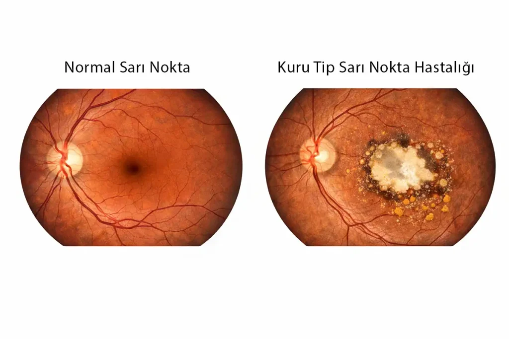 Sarı Nokta Hastalığı (AMD) Nedir? Kuru Tip, Yaş Tip, Tanı ve Tedavi